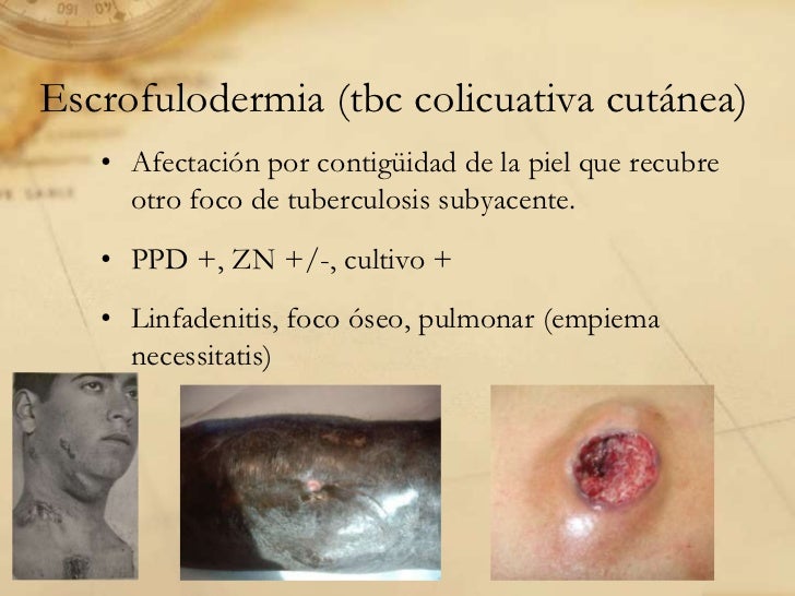 Empiema necessitatis