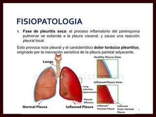 Empiema | PPTX