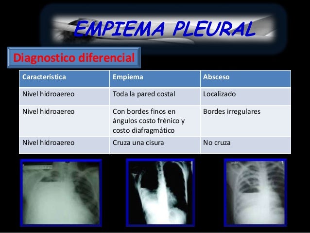 Empiema pleural