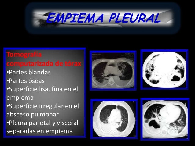 Empiema pleural