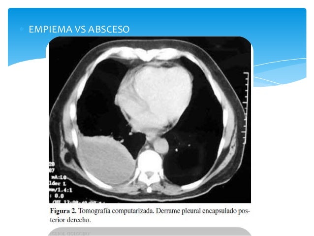 Empiema pulmonar