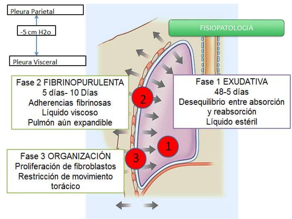 Empiema pulmonar