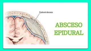 EMPIEMA SUBDURAL | PPTX