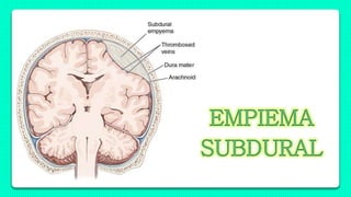 EMPIEMA SUBDURAL | PPTX