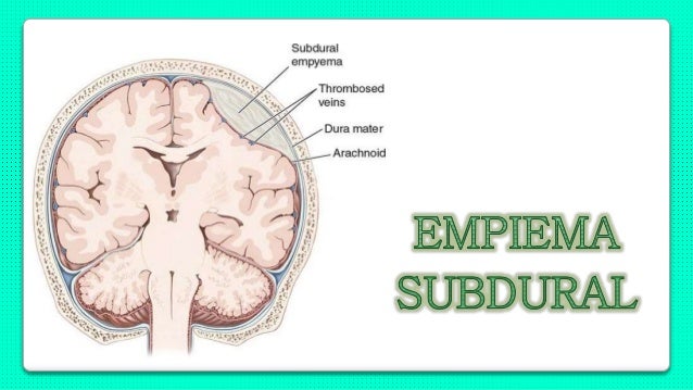 EMPIEMA SUBDURAL