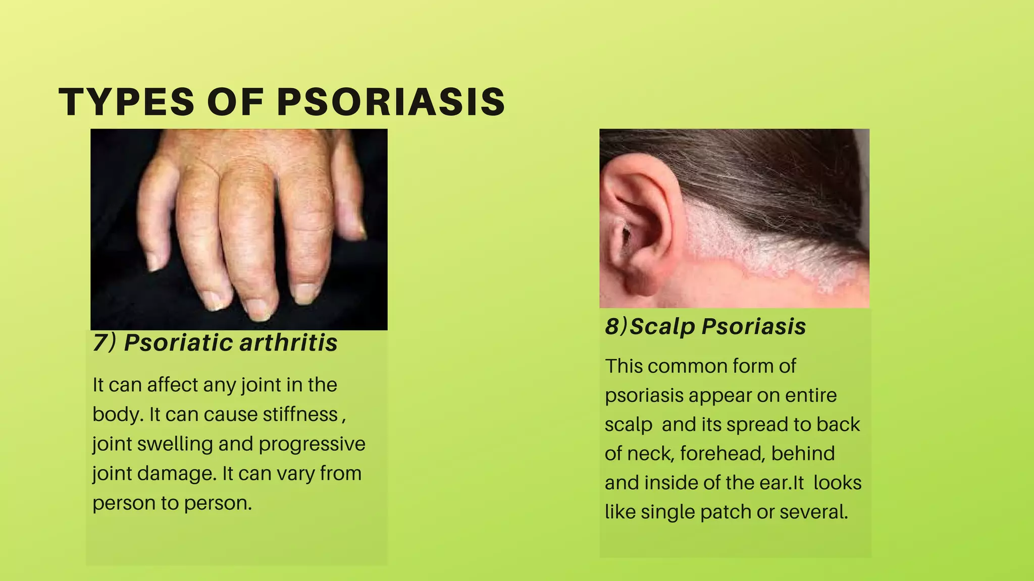 psoriasis permanently cure herbal products in india | PDF