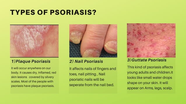 psoriasis permanently cure herbal products in india | PPT