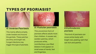 psoriasis permanently cure herbal products in india | PDF