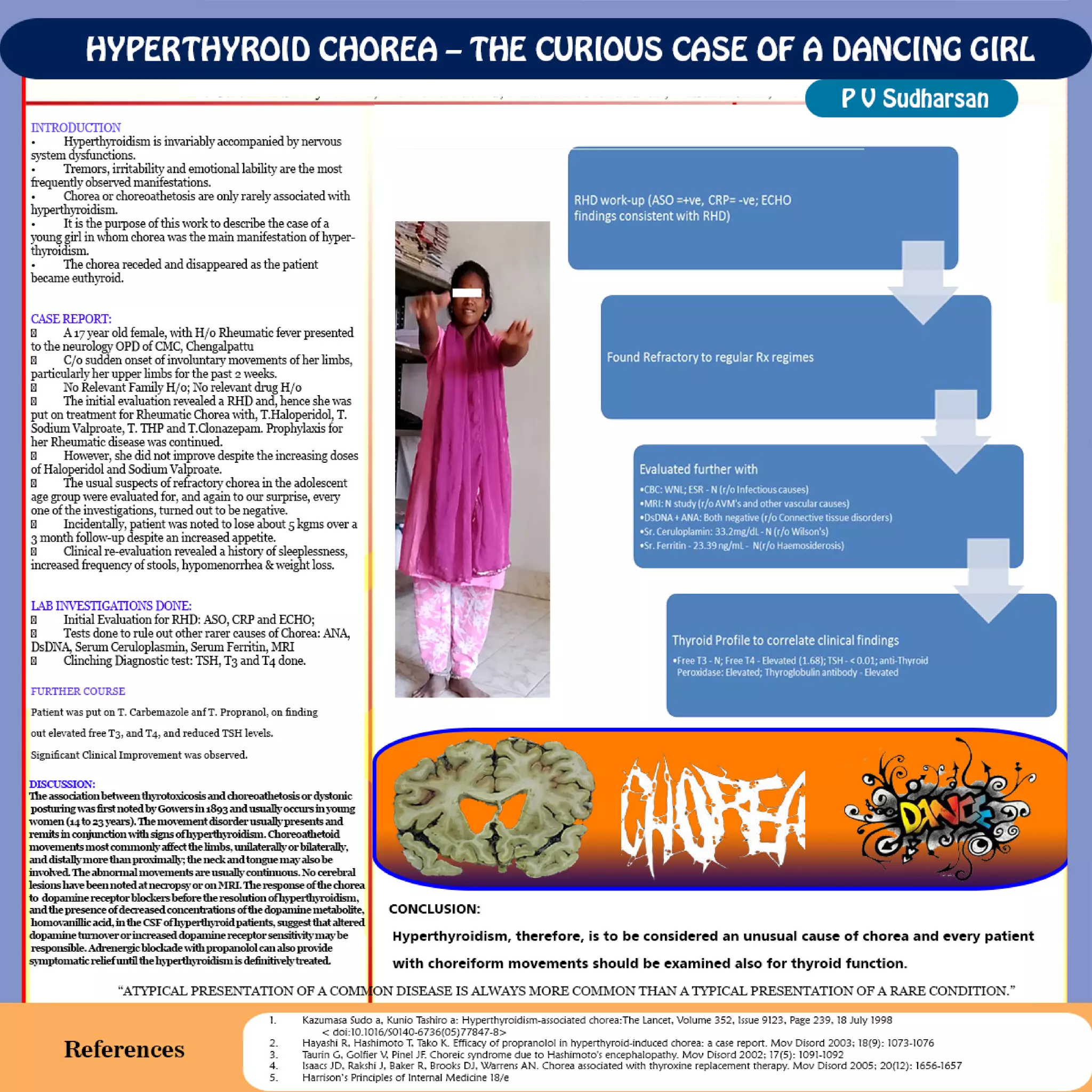 Hyperthyroid Chorea | PDF