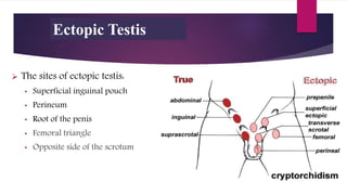 Empty scrotum | PPT