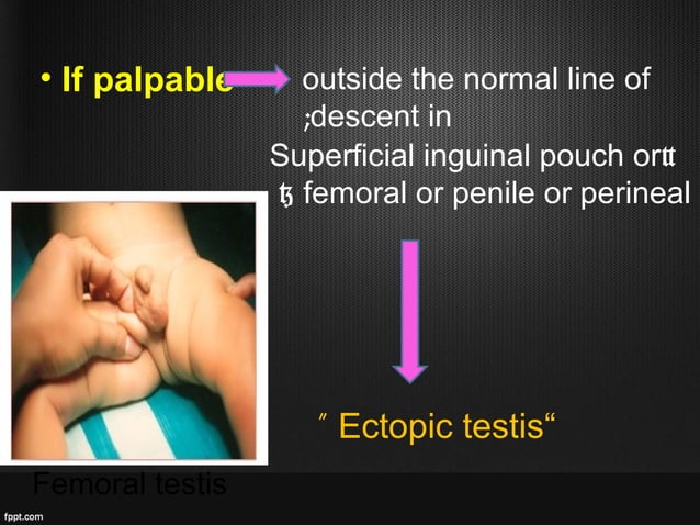 Empty scrotum | PPT