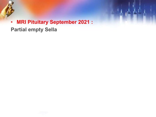 Empty sella presentation oncall duty .pptx