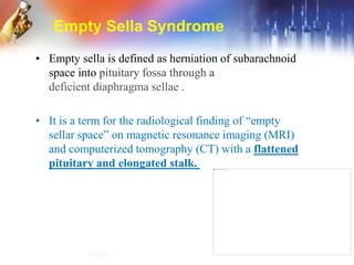 Empty sella presentation oncall duty .pptx