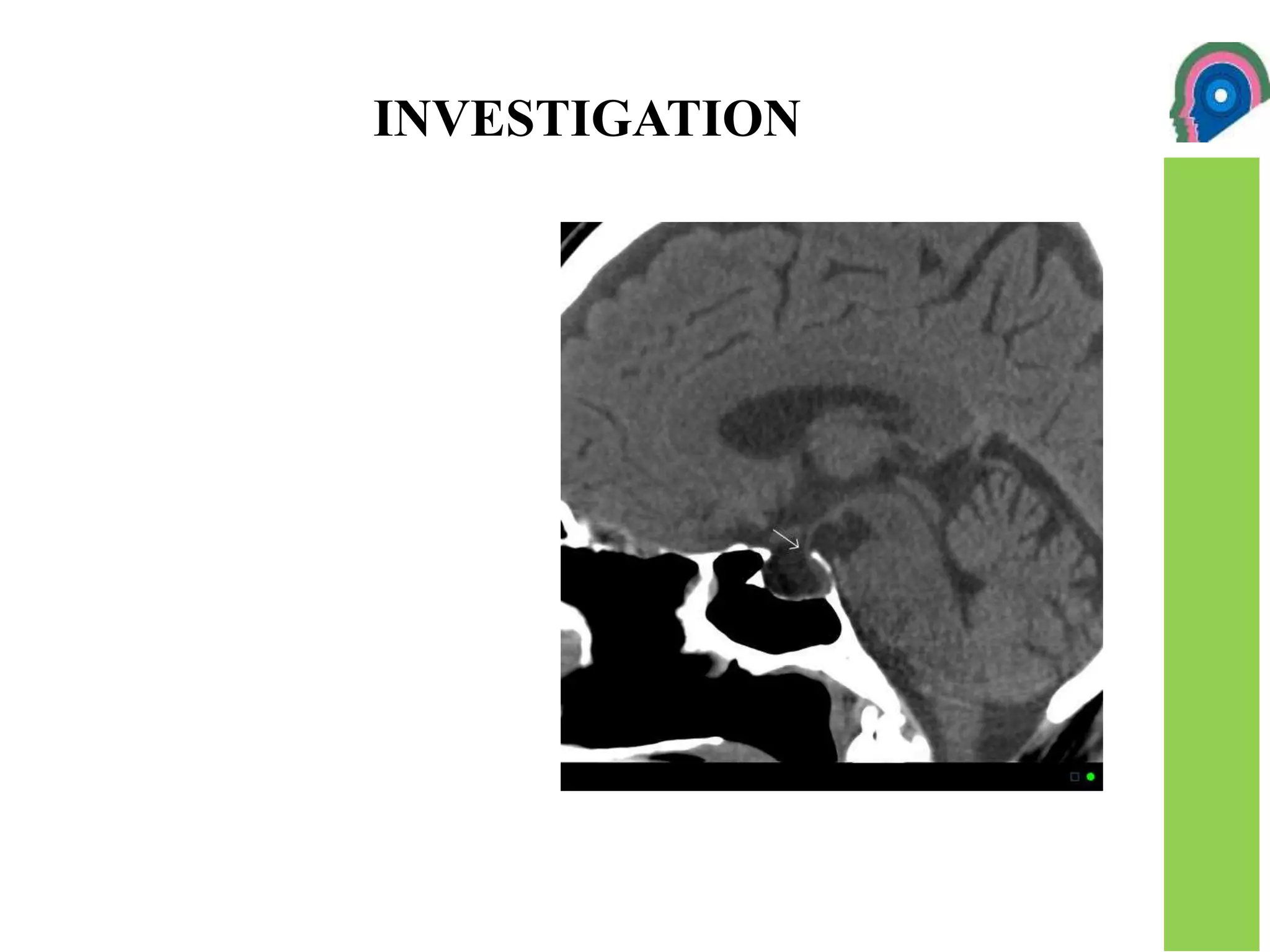 Empty sella syndrome | PPTX