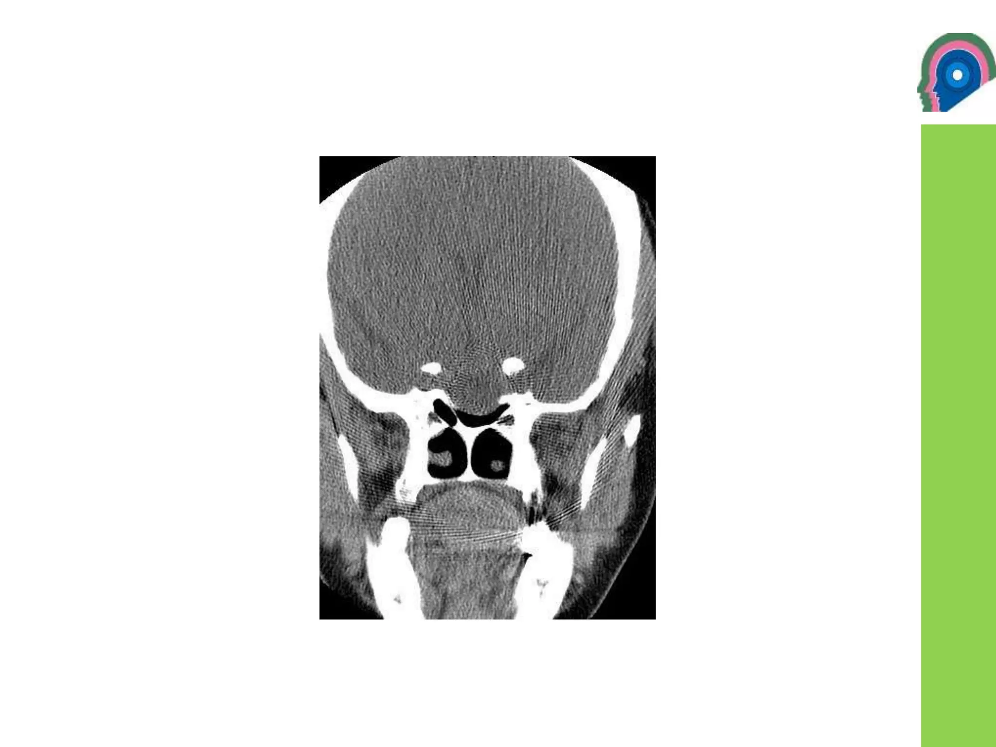 Empty sella syndrome | PPTX