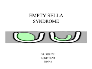 Empty sella syndrome | PPTX