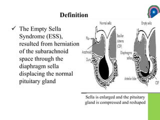Empty sella syndrome | PPTX
