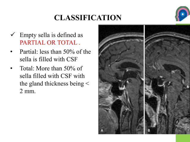 Empty sella syndrome