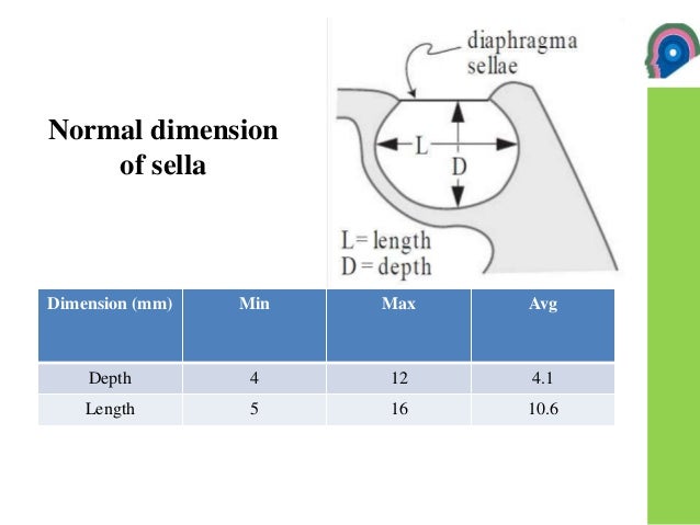 Empty sella syndrome