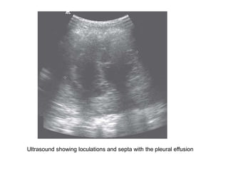 Empyema .ppt