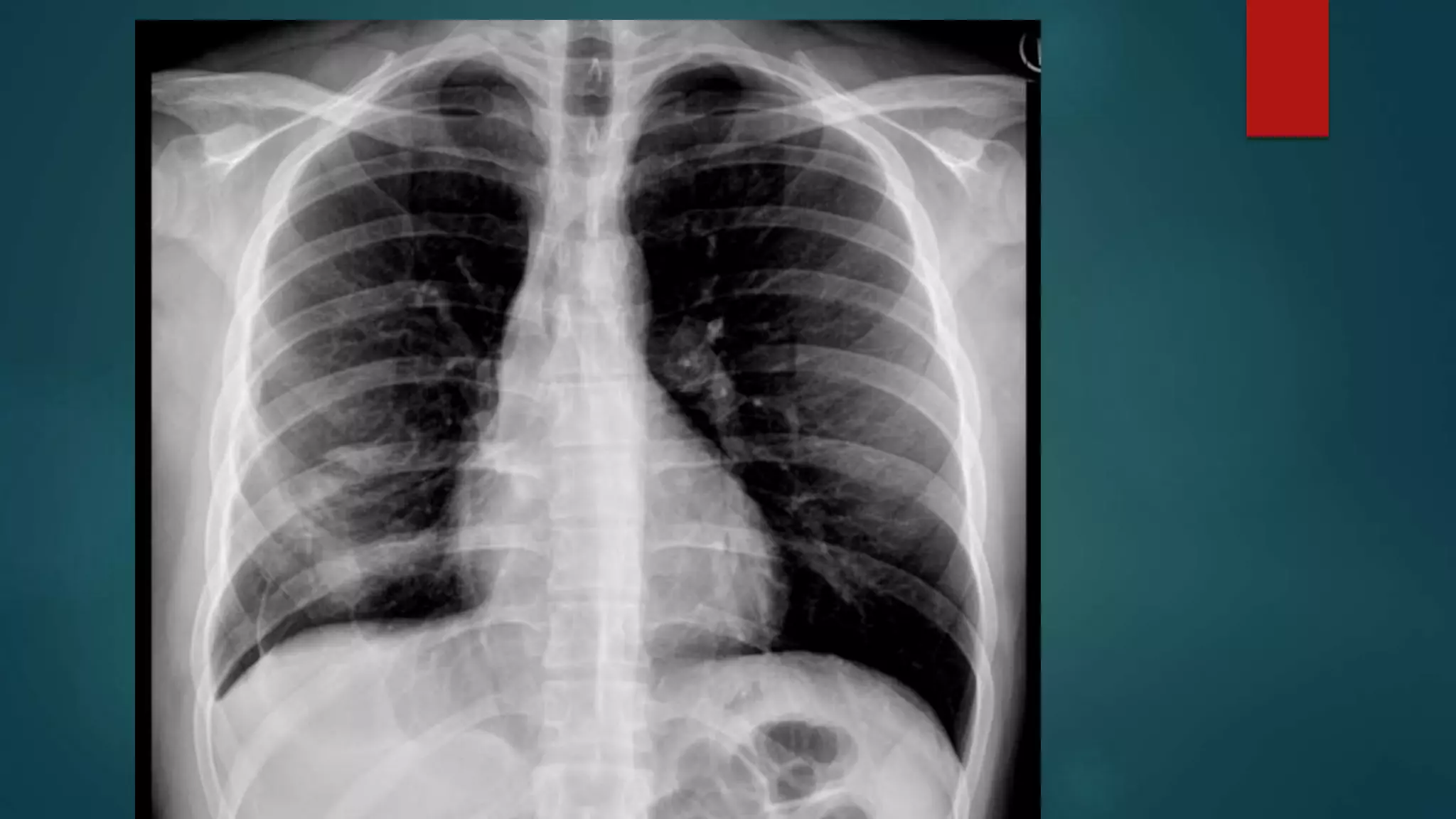 Empyema Necessitans.pptx