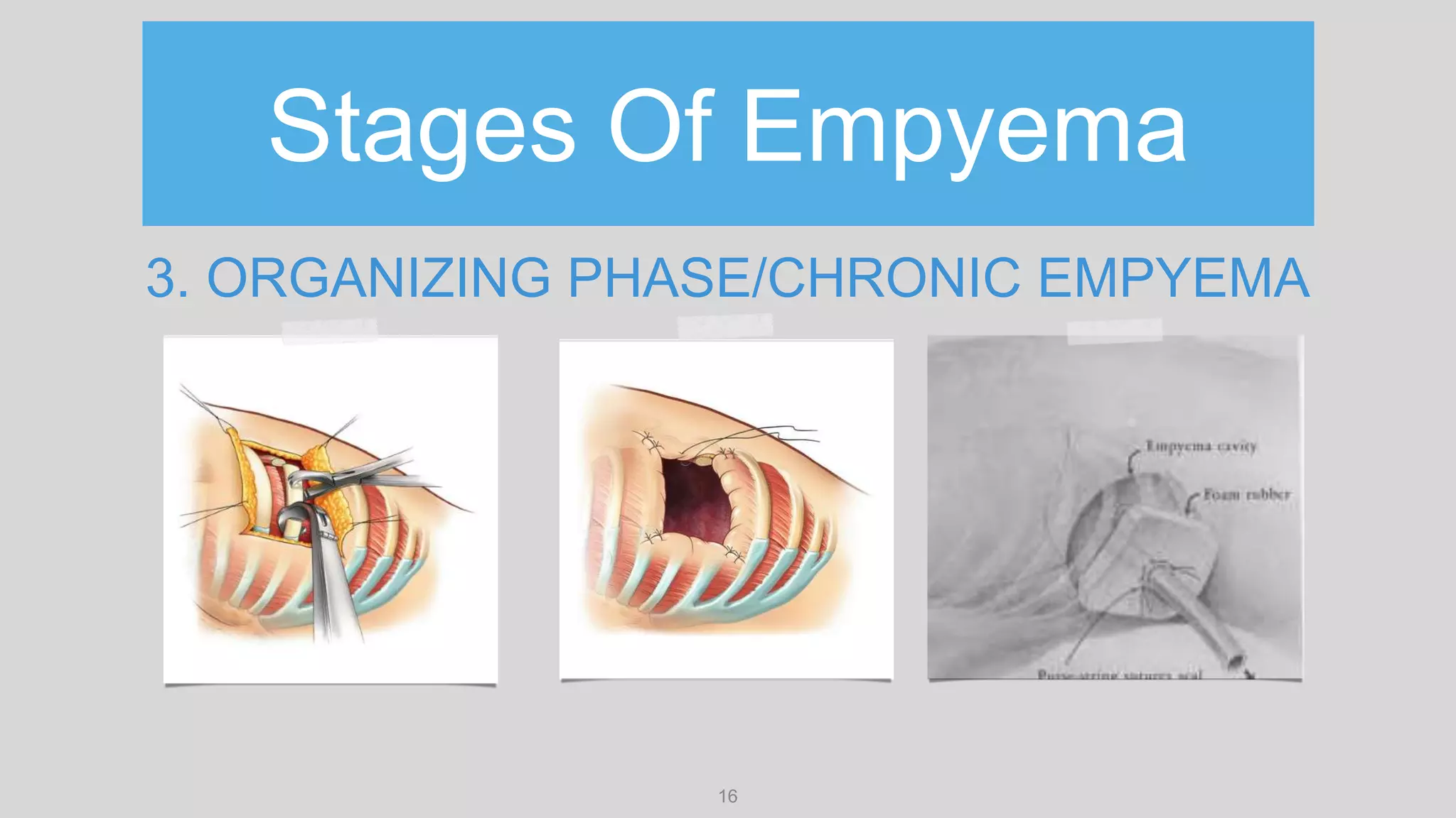Empyema Thoracis Final Pptx