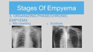 Empyema Thoracis Final.pptx