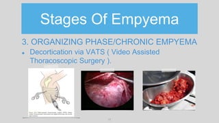 Empyema Thoracis Final.pptx
