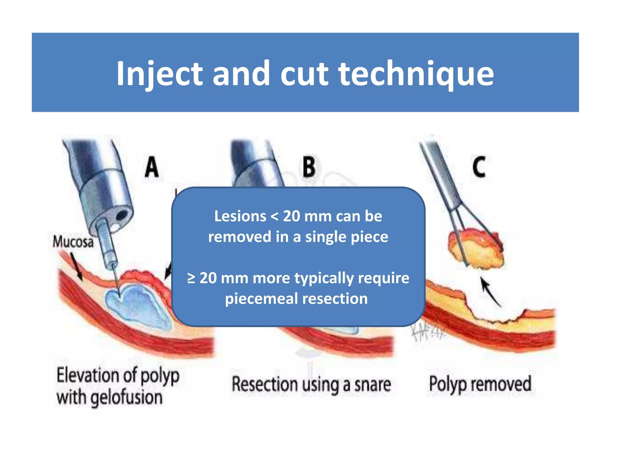 EMR/ endoscopic mucosal resection | PPTX