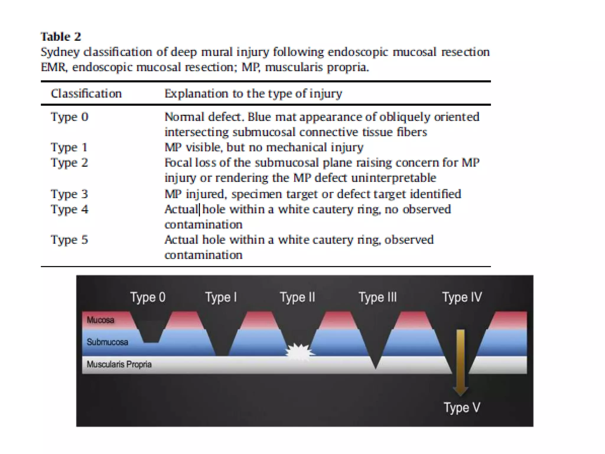 EMR/ endoscopic mucosal resection | PPTX