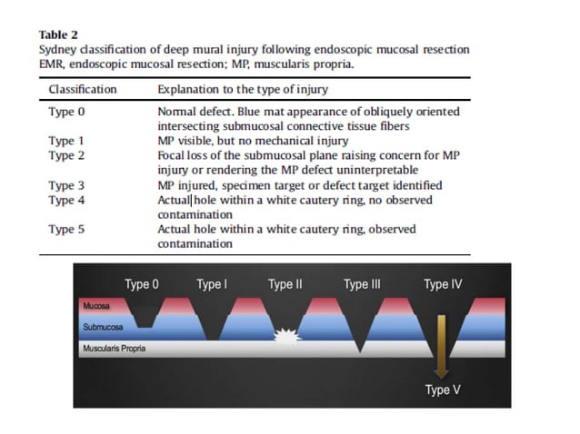EMR/ endoscopic mucosal resection | PPTX | Digestive Disorders ...