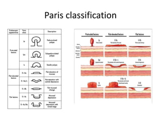 EMR/ endoscopic mucosal resection | PPTX
