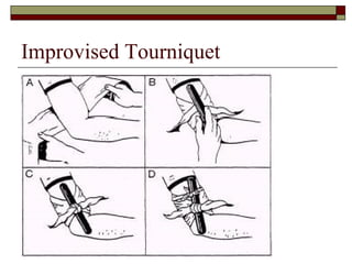 Emr tourniquet education_revised_april_11_2013 | PPT