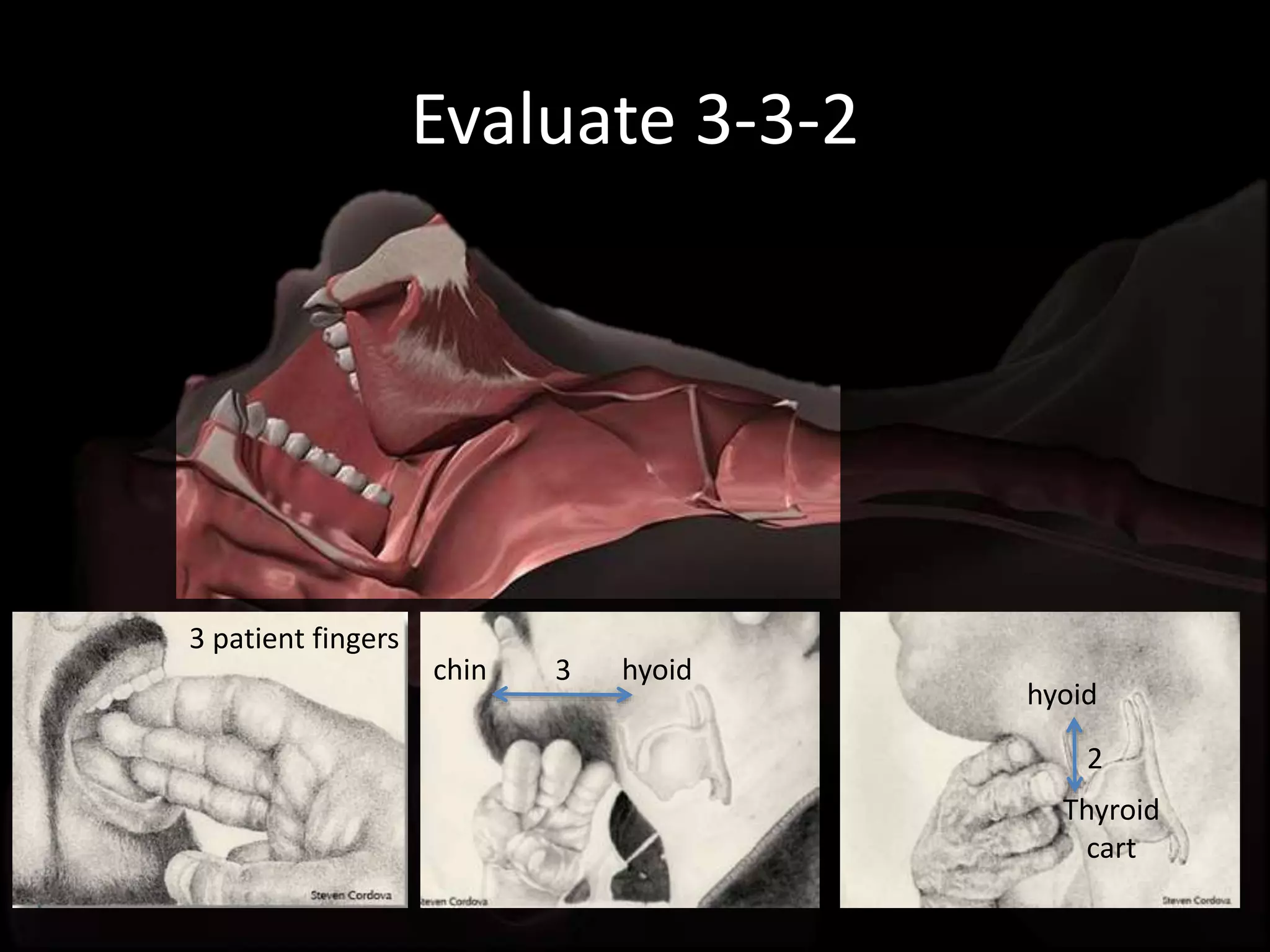 Ems difficult airway lecture symposium | PPTX