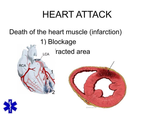 PREVIEW OF EMT/EMR CARDIOVASCULAR EMERGENCIES LESsON | PPTX