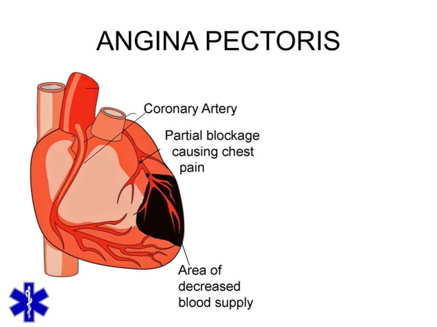 PREVIEW OF EMT/EMR CARDIOVASCULAR EMERGENCIES LESsON | PPTX