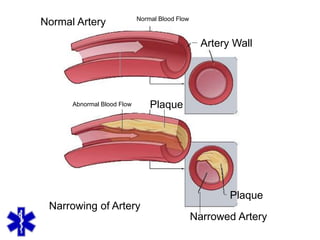 PREVIEW OF EMT/EMR CARDIOVASCULAR EMERGENCIES LESsON | PPTX