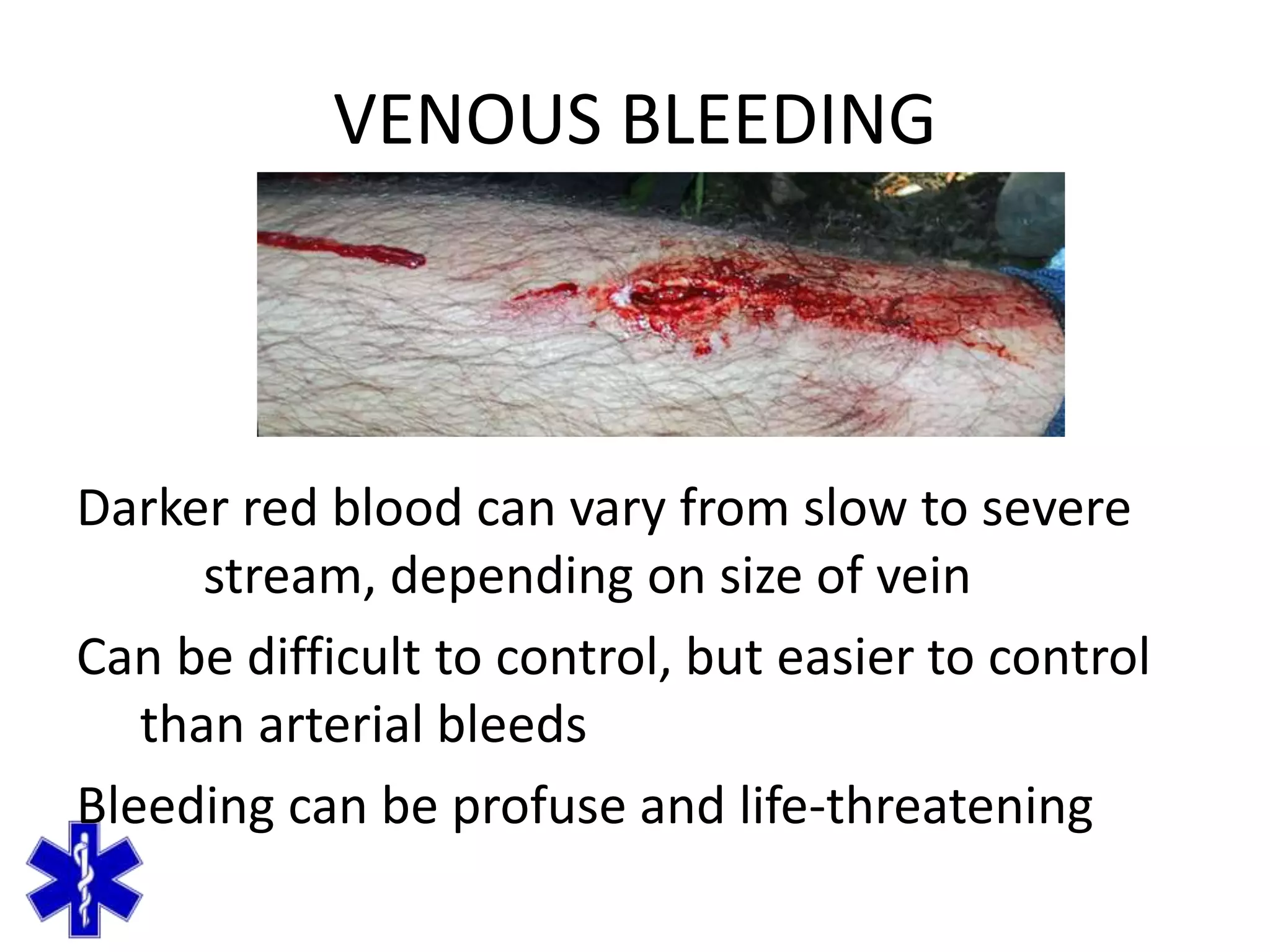 PREVIEW OF EMT/EMR BLEEDING POWERPOINT TRAINING PRESENTATION | PPTX