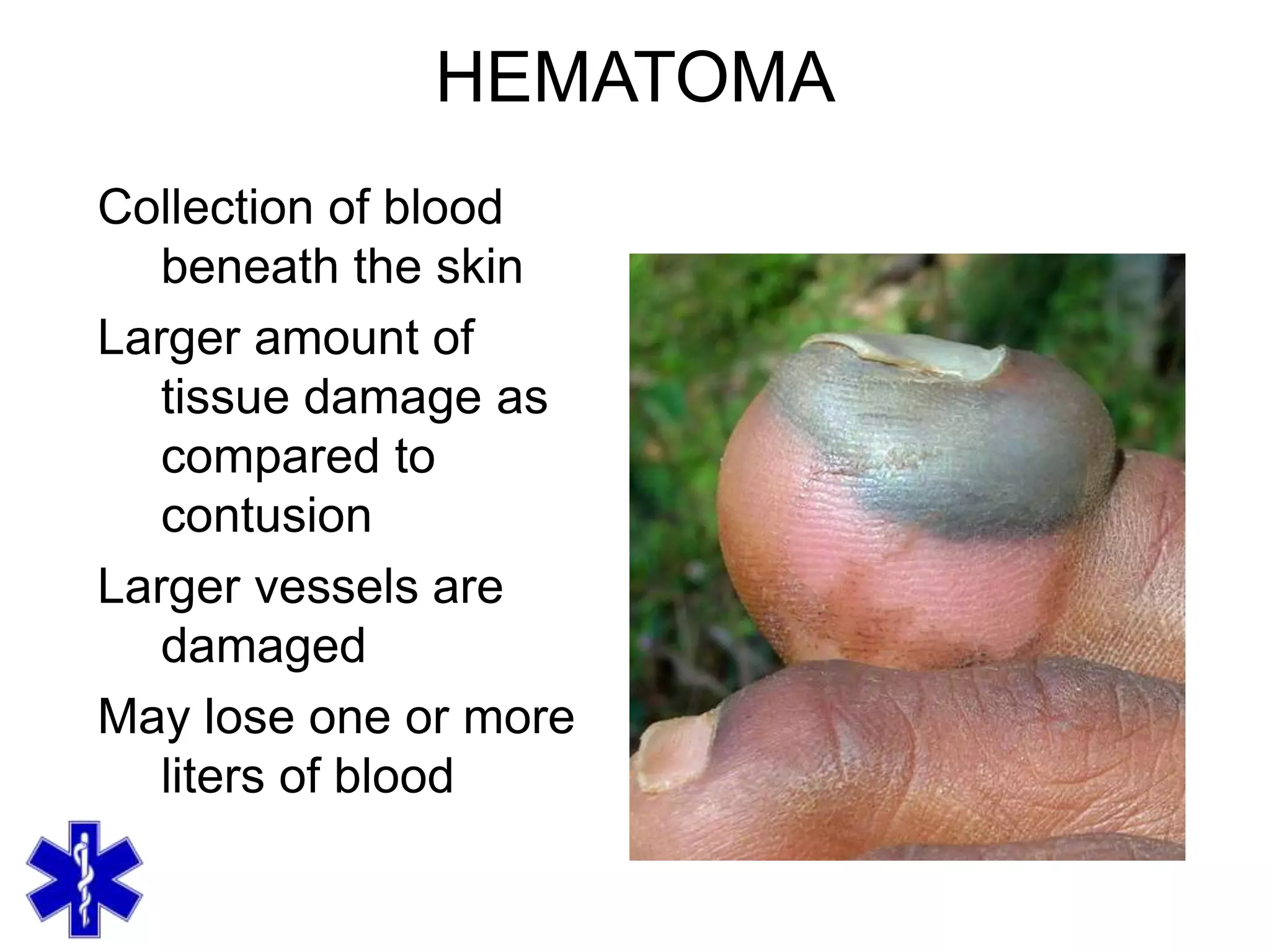 PREIEW OF EMT/EMR SOFT TISSUE POWERPOINT TRAINING PRESENTATION | PPTX