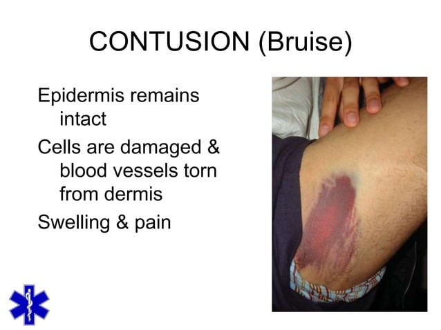 PREIEW OF EMT/EMR SOFT TISSUE POWERPOINT TRAINING PRESENTATION | PPTX ...