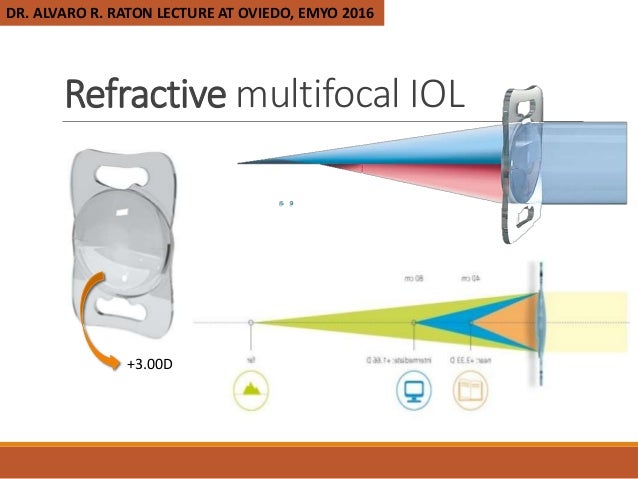 Update in intraocular lenses
