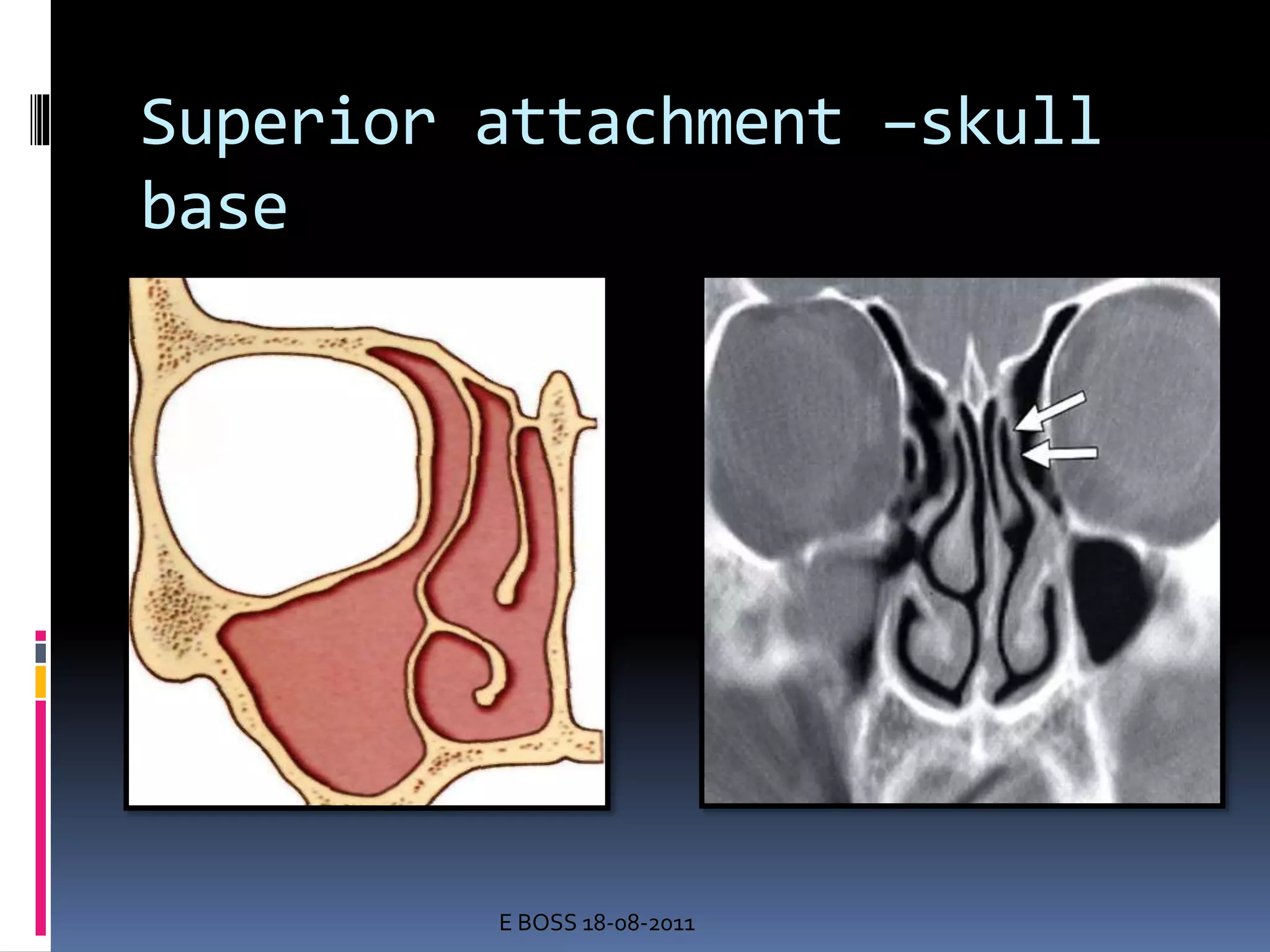endoscopic anatomy of nasal cavity | PPTX