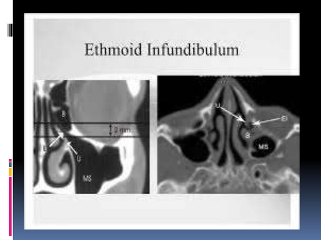 endoscopic anatomy of nasal cavity | PPTX | Ear, Nose and Throat ...