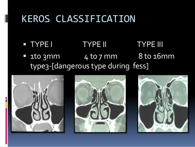 endoscopic anatomy of nasal cavity