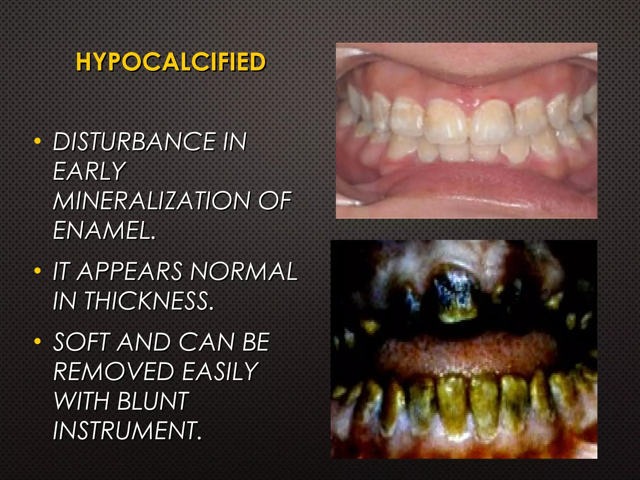 ENAMEL | PPT