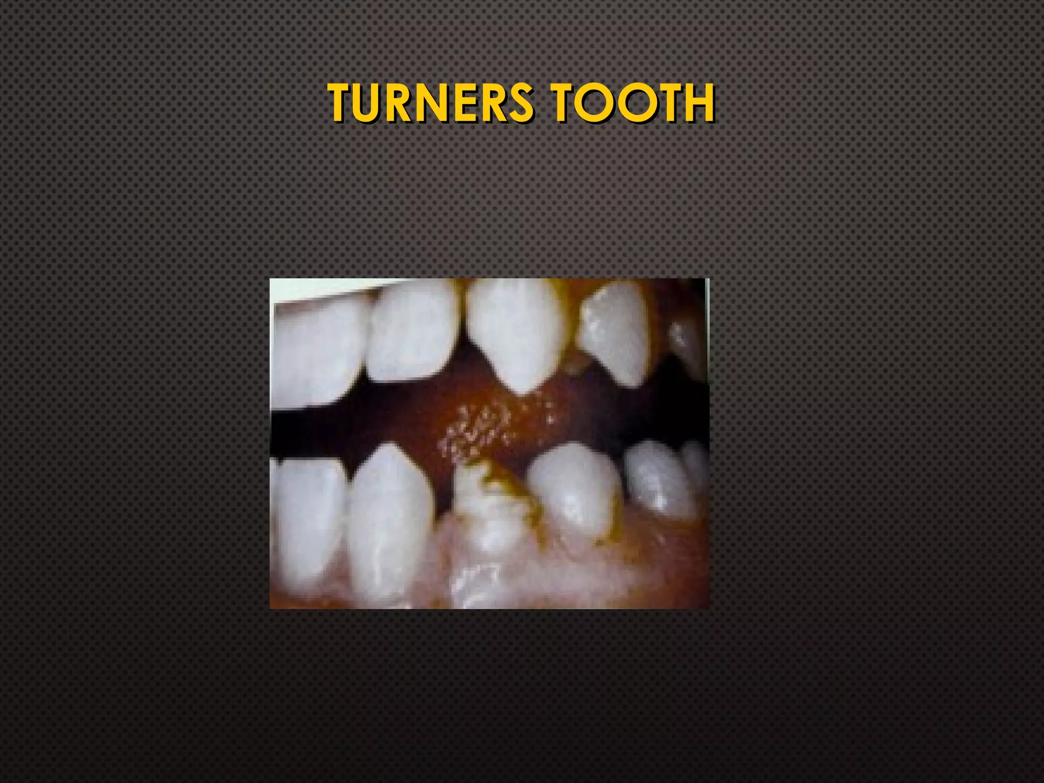 ENAMEL | PPT