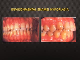 ENAMEL | PPT