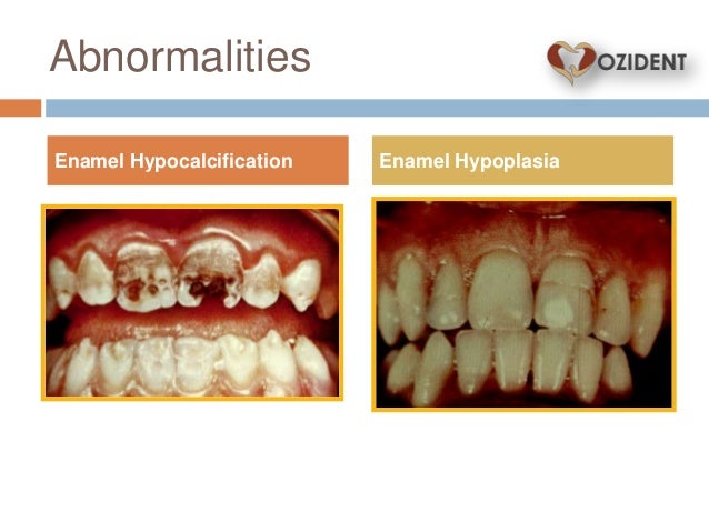 Dental Anatomy: Enamel