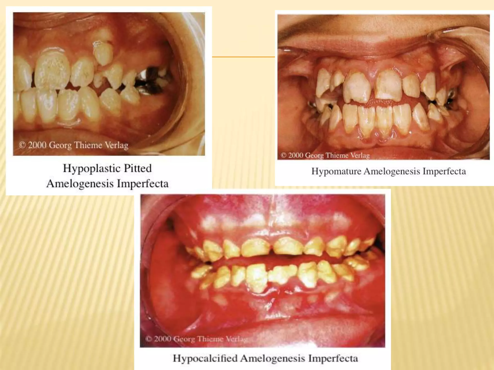 Enamel defects | PPTX