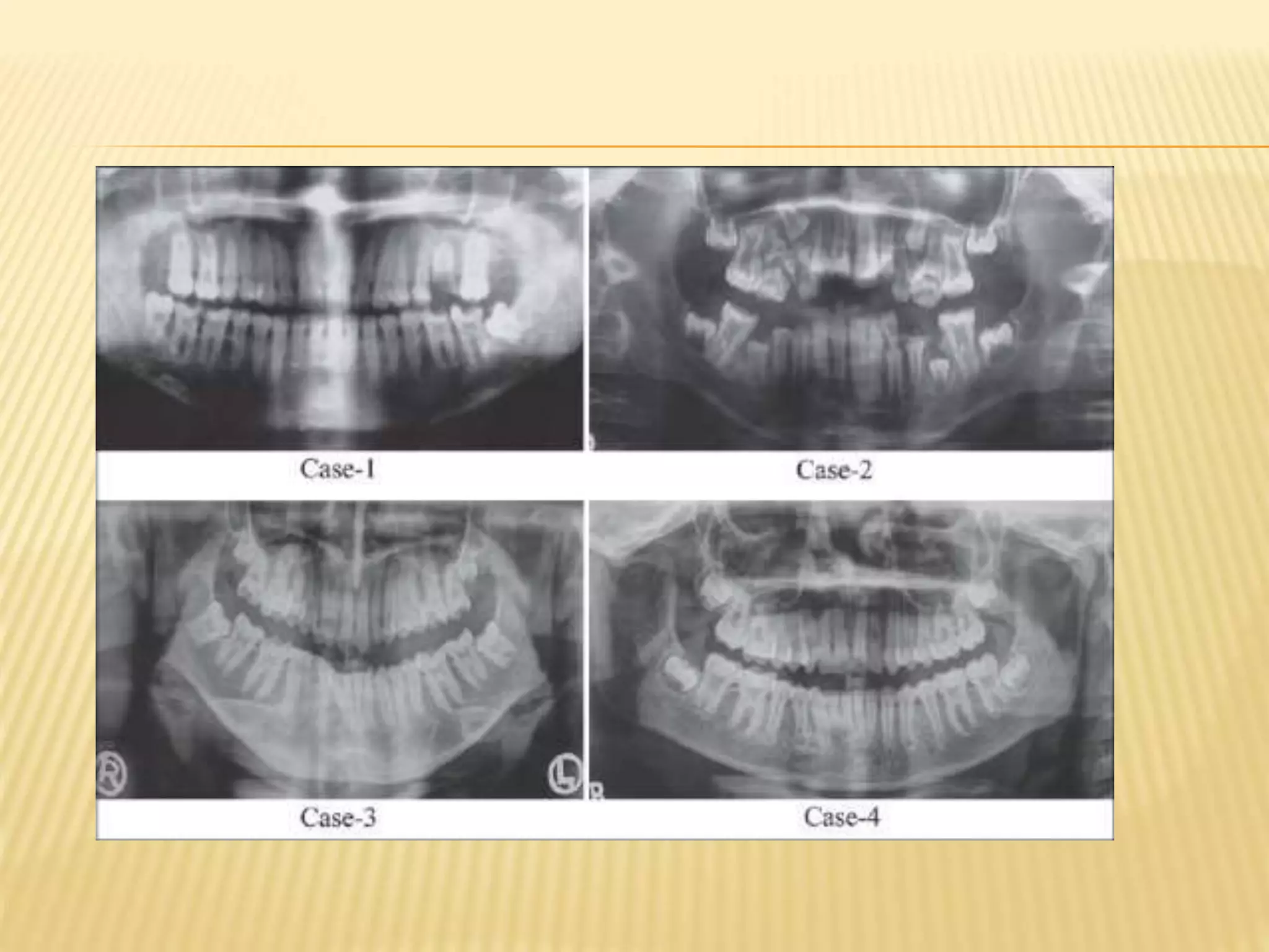 Enamel defects | PPTX